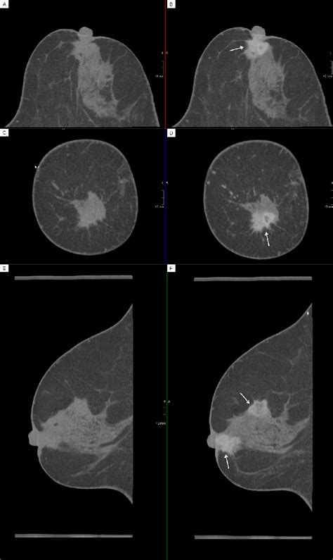 example of in vivo absorption contrast breast computed tomography download scientific diagram