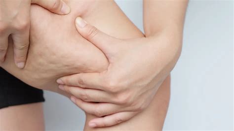 S Ntomas De La Celulitis C Mo Se Diagnostica Esta Condici N De La Piel