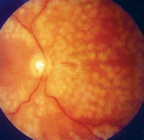 Laser Pan Retinal Photocoagulation Oscestop