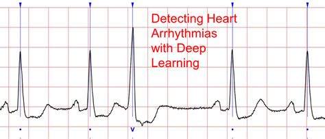 detecting heart arrhythmias with deep learning in keras with dense cnn and lstm by andrew