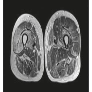 Magnetic Resonance Imaging MRI Of Bilateral Thigh Muscles Of A Woman