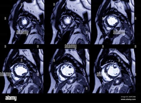 MRI Heart Or Cardiac MRI In Short Axis View Showing Cross Sections Of