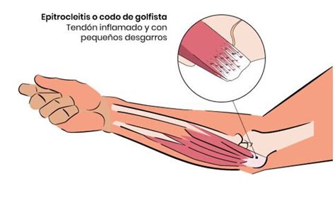 Epitrocleitis Dr Revenga Giertych Traumatólogo en Cádiz