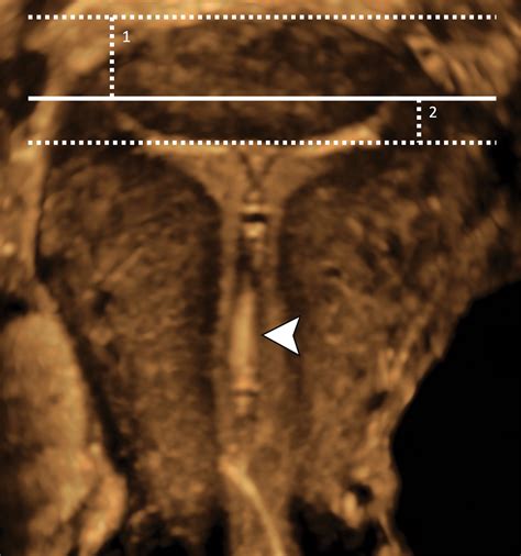 Müllerian Duct Anomalies Role in Fertility and Pregnancy RadioGraphics