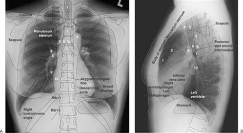 X Ray Chest Anatomy
