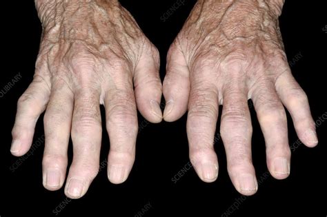 Osteoarthritis Hands