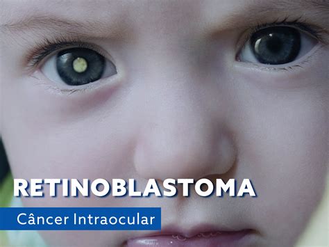O Que Retinoblastoma Oftalmo Santos