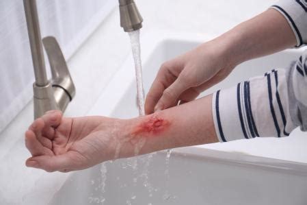 Cómo actuar ante quemaduras de tercer grado