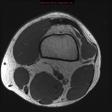 Knee Mri Anatomy Axial Diagram Quizlet
