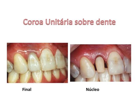 PPT Prótese Dentária PowerPoint Presentation free download ID 4105325