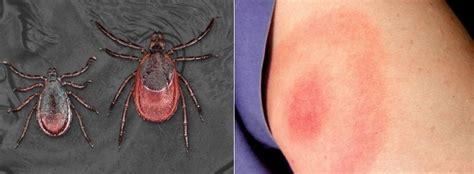 Qué es la enfermedad de Lyme
