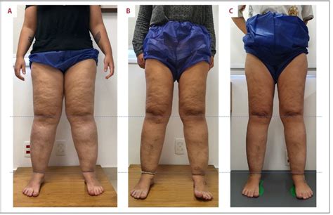 Lipedema Fotos Dr João Bragagnollo