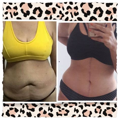Diário da Nay Bariátrica 3 MESES ABDOMINOPLASTIA EM ANCORA