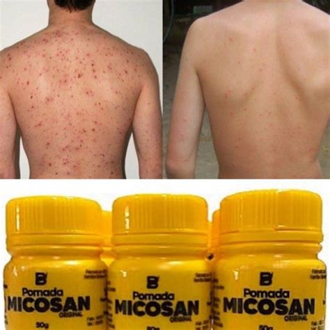 Creme Micosan Anti Foliculite Clareador E Micose Em Geral 50g Shopee
