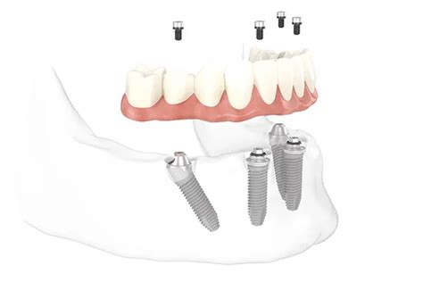 All on 4 einfach erklärt Methode für schnelle Implantate