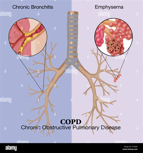 Illustration Of Chronic Obstructive Pulmonary Disease COPD A Common