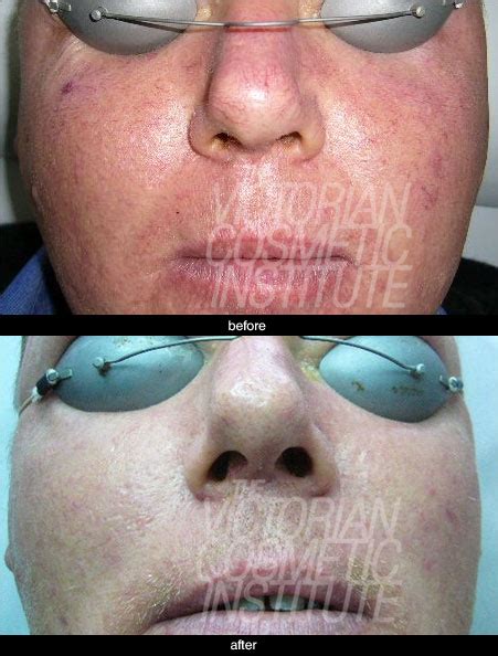 Vascular Laser Treatment Melbourne Gemini Laser