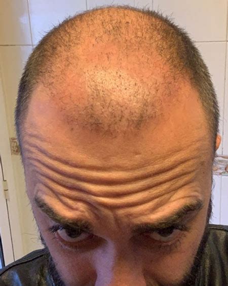 Injerto Capilar Antes Y Despu S Resultados Capilclinic Colombia