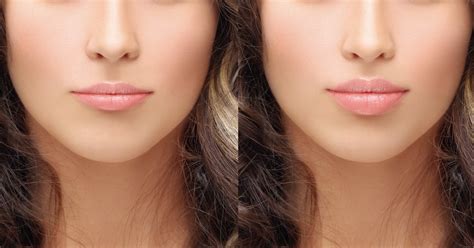 Fases do preenchimento labial conheça os efeitos