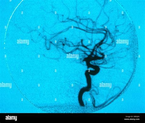 Angiogram Of Cerebral Blood Vessels Stock Photo Alamy