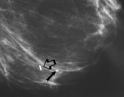 Metallic Marker Placement After Stereotactic Core Biopsy Of Breast