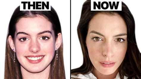 Truth Behind Anne Hathaway Look Plastic Surgery Analysis YouTube