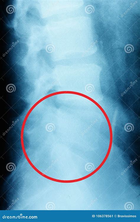 Filme La Espina Dorsal Lumbar De La Radiograf A Espina Dorsal Ap