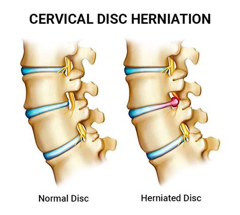 Cervical Disc Herniation Doctors NJ NYC