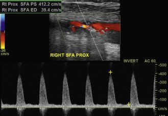 Deep Femoral Artery Ultrasound
