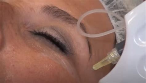 Qué es la mesoterapia facial y para qué sirve Blog animalista