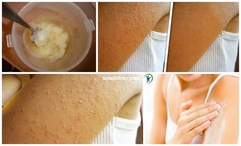 Como Eliminar Los Granitos De Los Brazos Skin Care Secrets French