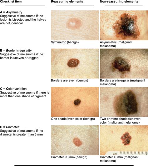 List 102 Pictures Early Stage Of Melanoma Pictures Superb