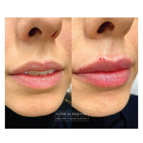 Descubre cómo perfilar tus labios con ácido hialurónico en fotos