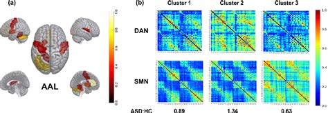 [pdf] spatio temporal attention in multi granular brain chronnectomes for detection of autism