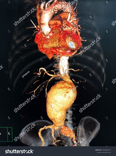 Ct Scan Imaging Abdominal Aortic Aneurysm Stock Photo