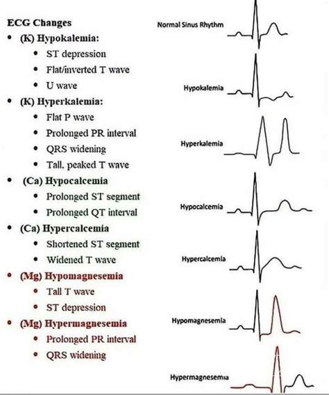 Snapshot Of ECG Changes In Electrolytes Imbalance MEDizzy
