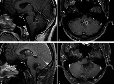 Preoperative Sagittal A And Axial B Gd Enhanced T1 Weighted MR