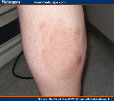 Tinea Incognito