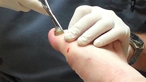 Toenail Off Treatment At Doris Warren Blog