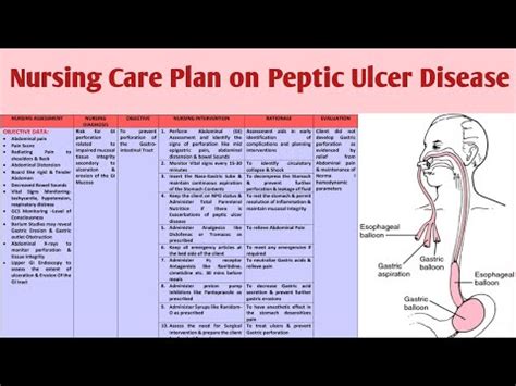 NCP 13 Nursing Care Plan On Peptic Ulcer Disease GI Disorders YouTube