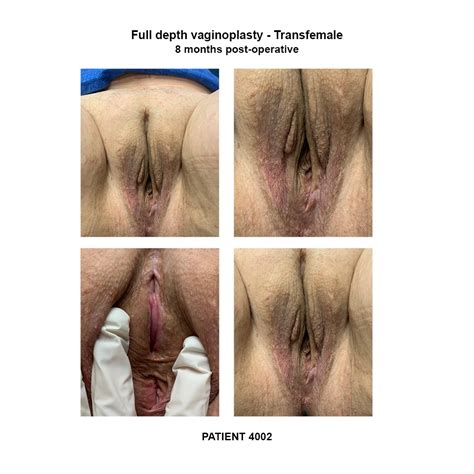 MTF Vaginoplasty Results Gallery Keelee MacPhee M D