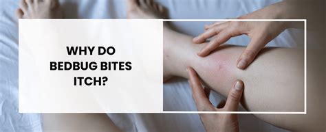 Why Do Bedbug Bites Itch Bed Bug 911