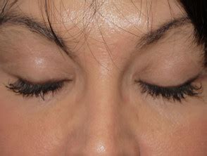 Bimatoprost Dermatly De Site Voor Uw Huid