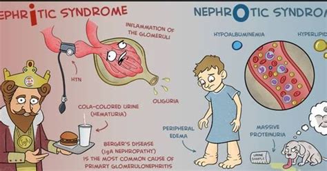 Treatment For Kidney Disease What Are The Causes Of Nephrotic Syndrome