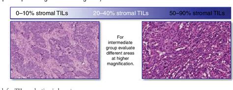 PDF The Evaluation Of Tumor Infiltrating Lymphocytes TILs In Breast