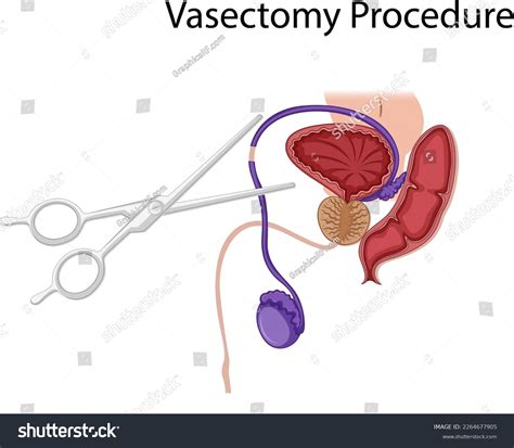Diagram Showing Vasectomy Procedure Illustration Stock Vector Royalty