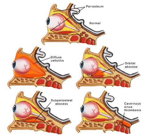 Preseptal Cellulitis Vs Orbital Cellulitis