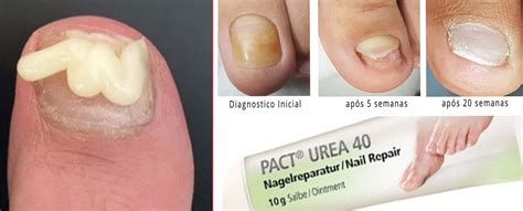 Descubrir Imagen Como Curar U As Con Onicomicosis Viaterra Mx