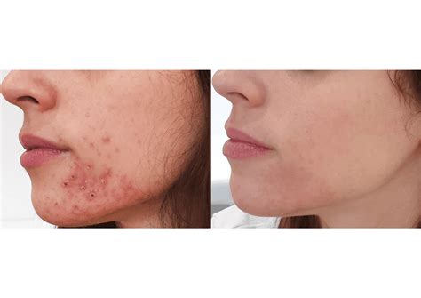 Láser CO2 para Acné y Cicatrices Clínica Dermatológica Alcalá