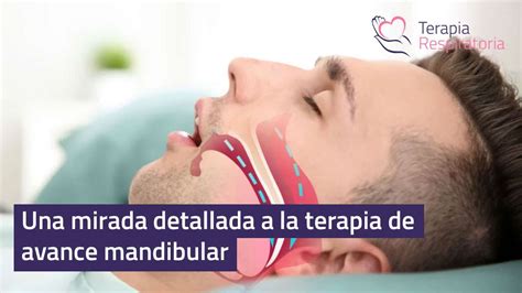 Terapia de avance mandibular para tratar la apnea del sueño